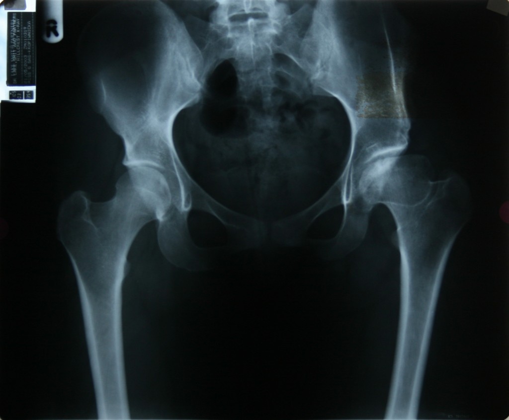 Perthes Disease, Personal Experience and into adulthood - Violetsteel